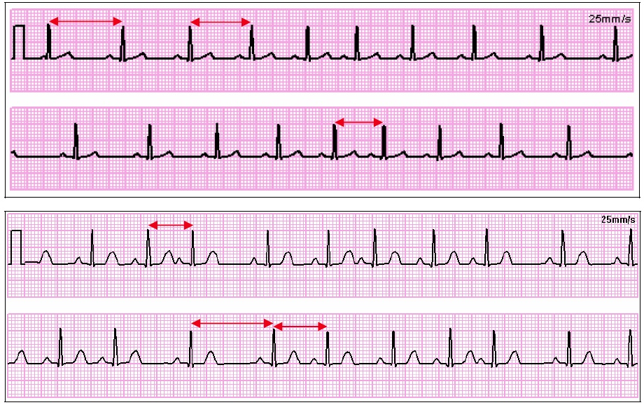 Recognizing ECG Irregularities Favoriteplus Blog Recognizing ECG Irregularities Favoriteplus Blog