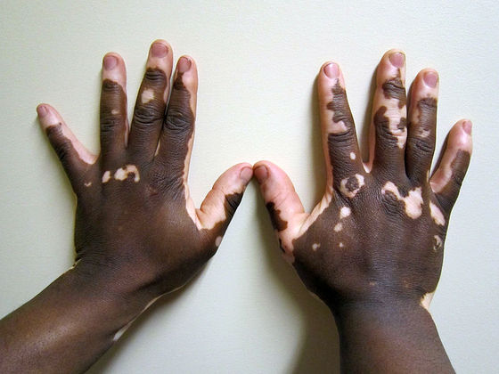 How Does a Person Get Vitiligo? - Favoriteplus.com Blog