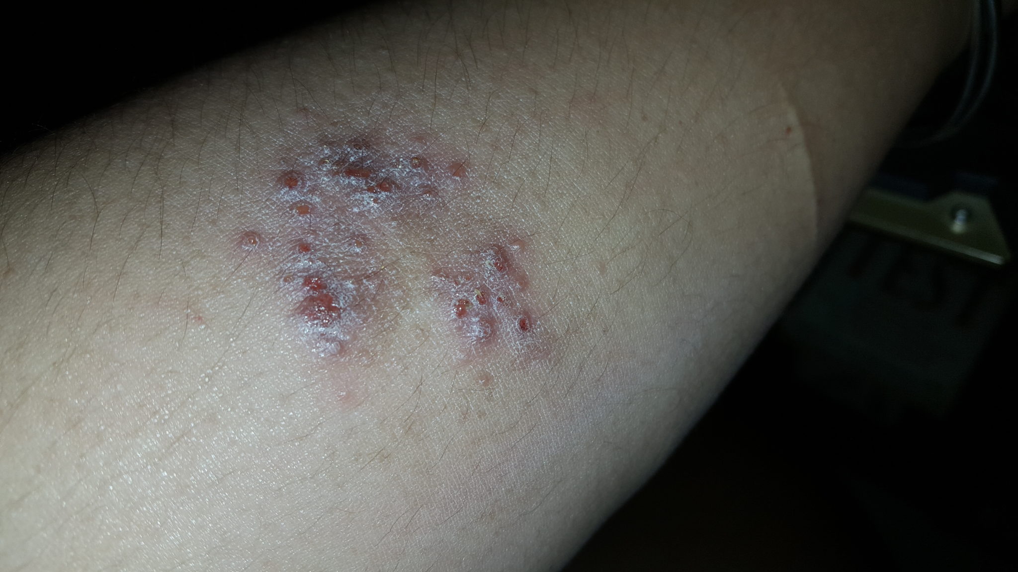 Can You Get Rid of Eczema for Good? - Favoriteplus.com Blog