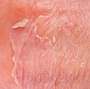 How Long Does Eczema Last? - Favoriteplus.com Blog